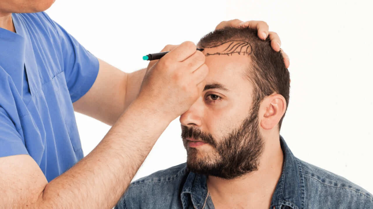 Turkey Hair Transplant Packages: Affordable Solutions with Flexible ...